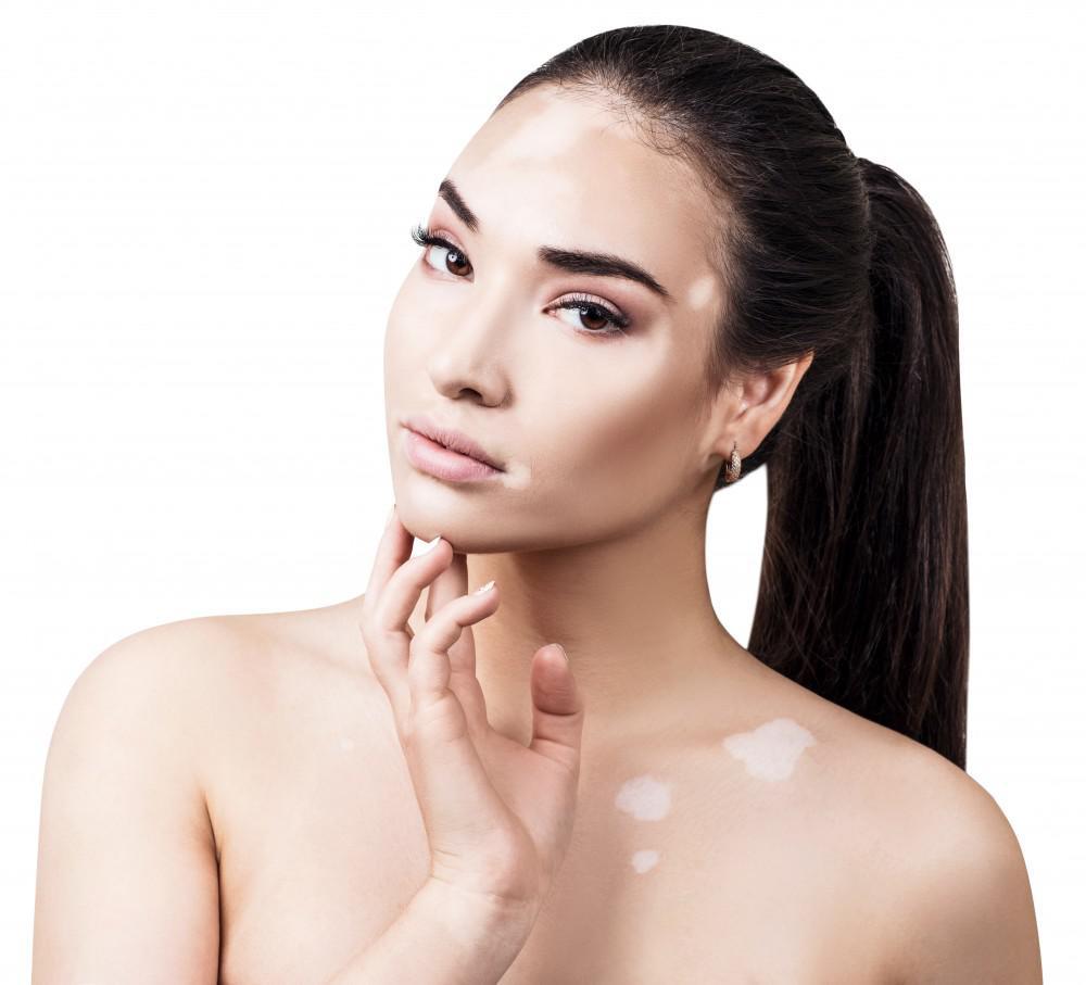 Bệnh lang ben và những điều cần biết về bệnh