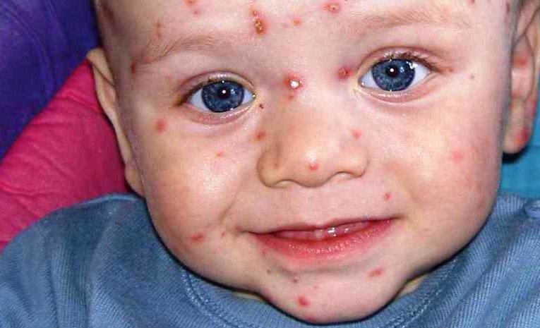 Tìm hiểu về Varicella Zoster Virus gây ra bệnh thuỷ đậu