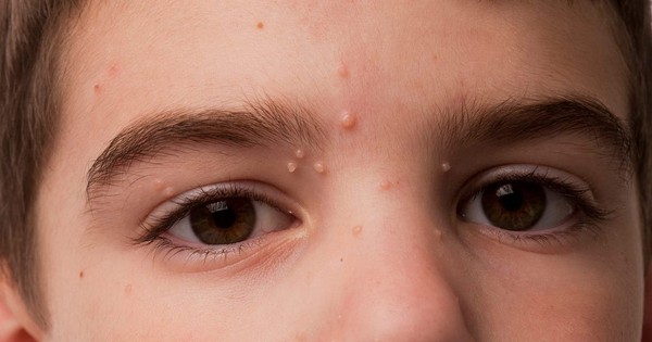 U mềm lây: Nguyên nhân, triệu chứng, giai đoạn và cách điều trị